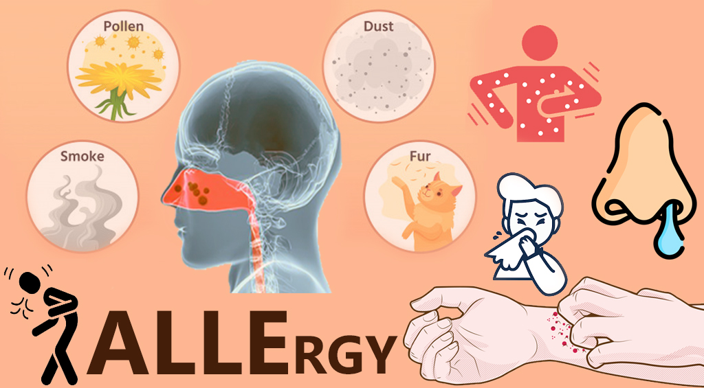 Allergy - Japan Guide